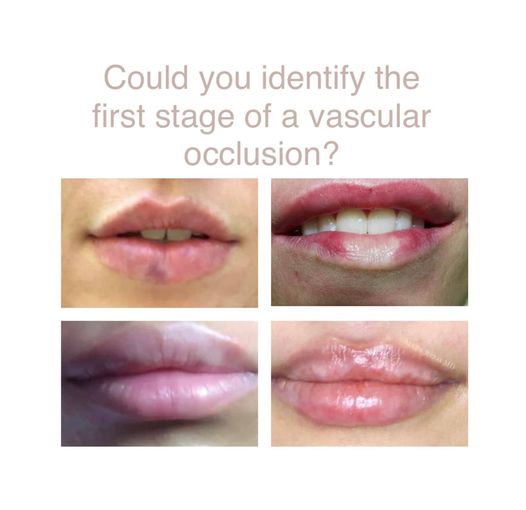 Dermal Filler Complications – Claudette Clinic